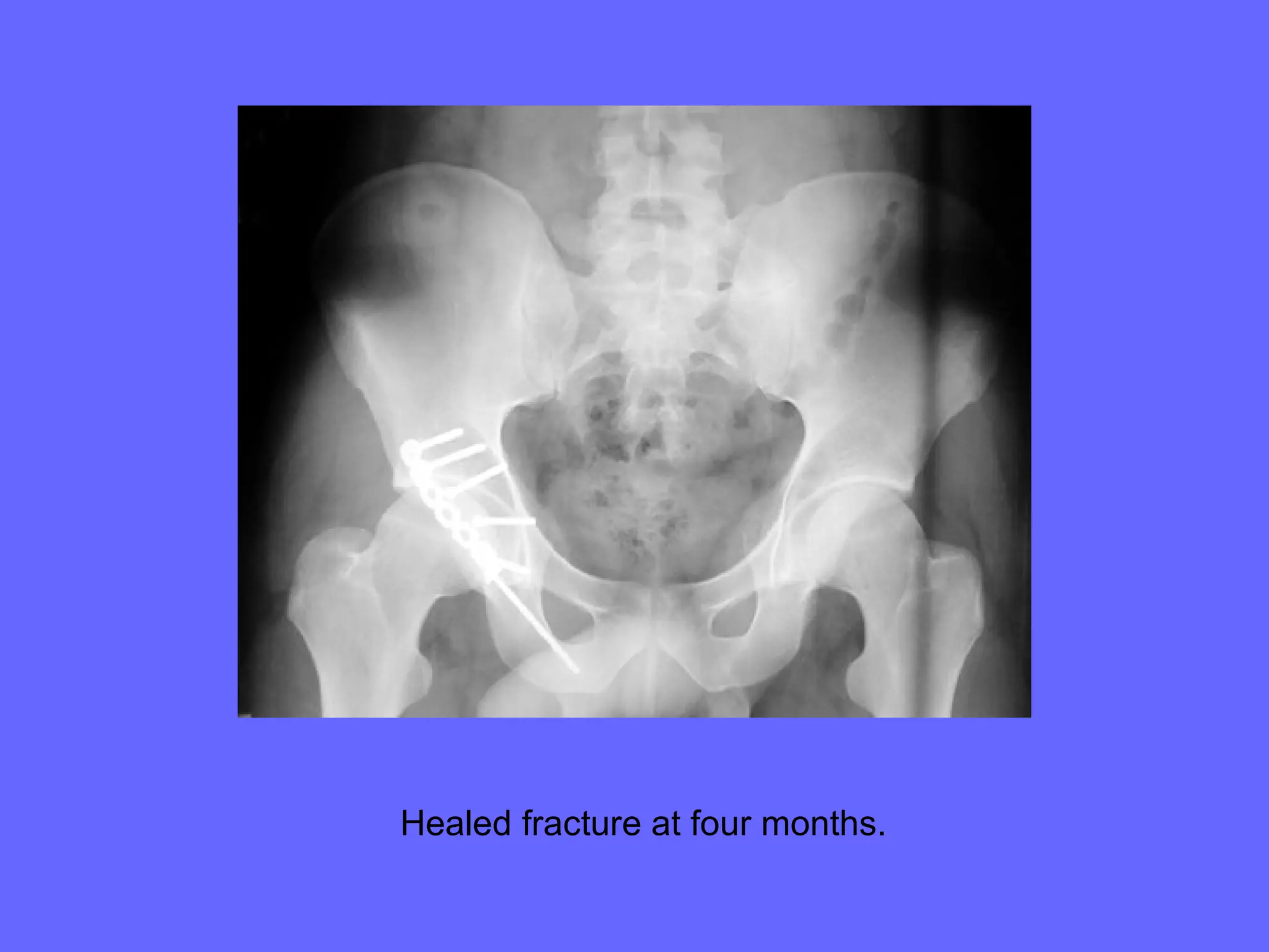 FRACTURES OF ACETABULUM.ppt fractures around hip | PPT