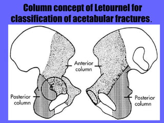 FRACTURES OF ACETABULUM.ppt fractures around hip | PPT