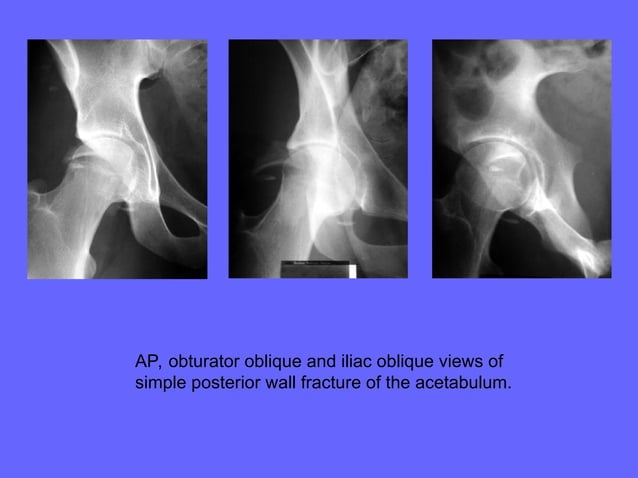 FRACTURES OF ACETABULUM.ppt fractures around hip | PPT