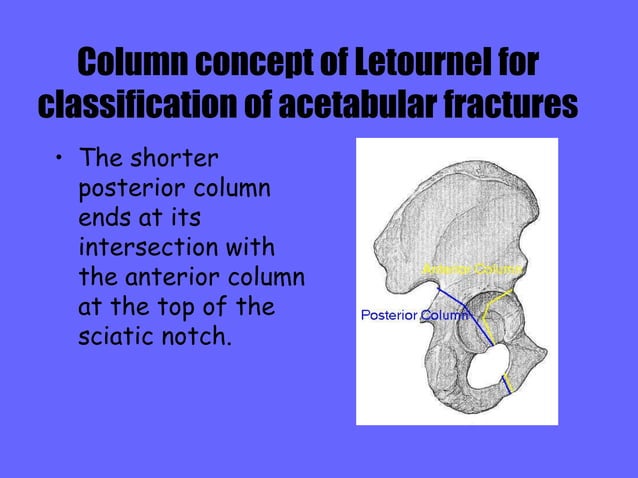 FRACTURES OF ACETABULUM.ppt fractures around hip | PPT