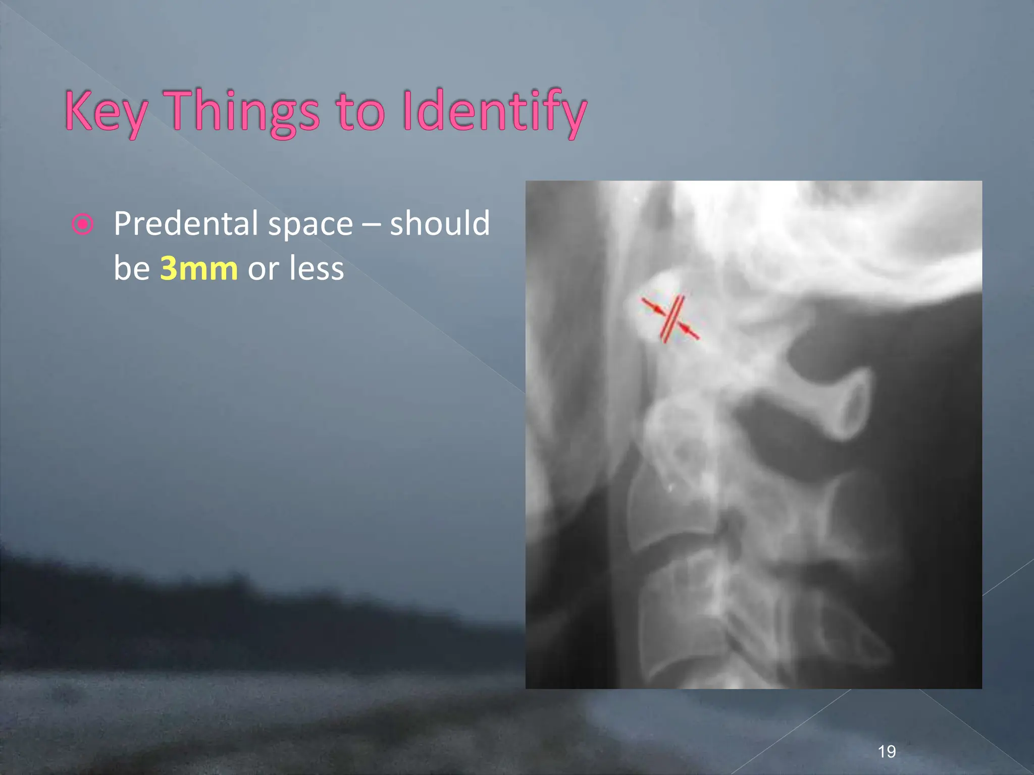 fractures of cervical spine and applied anatomy revised.pptx
