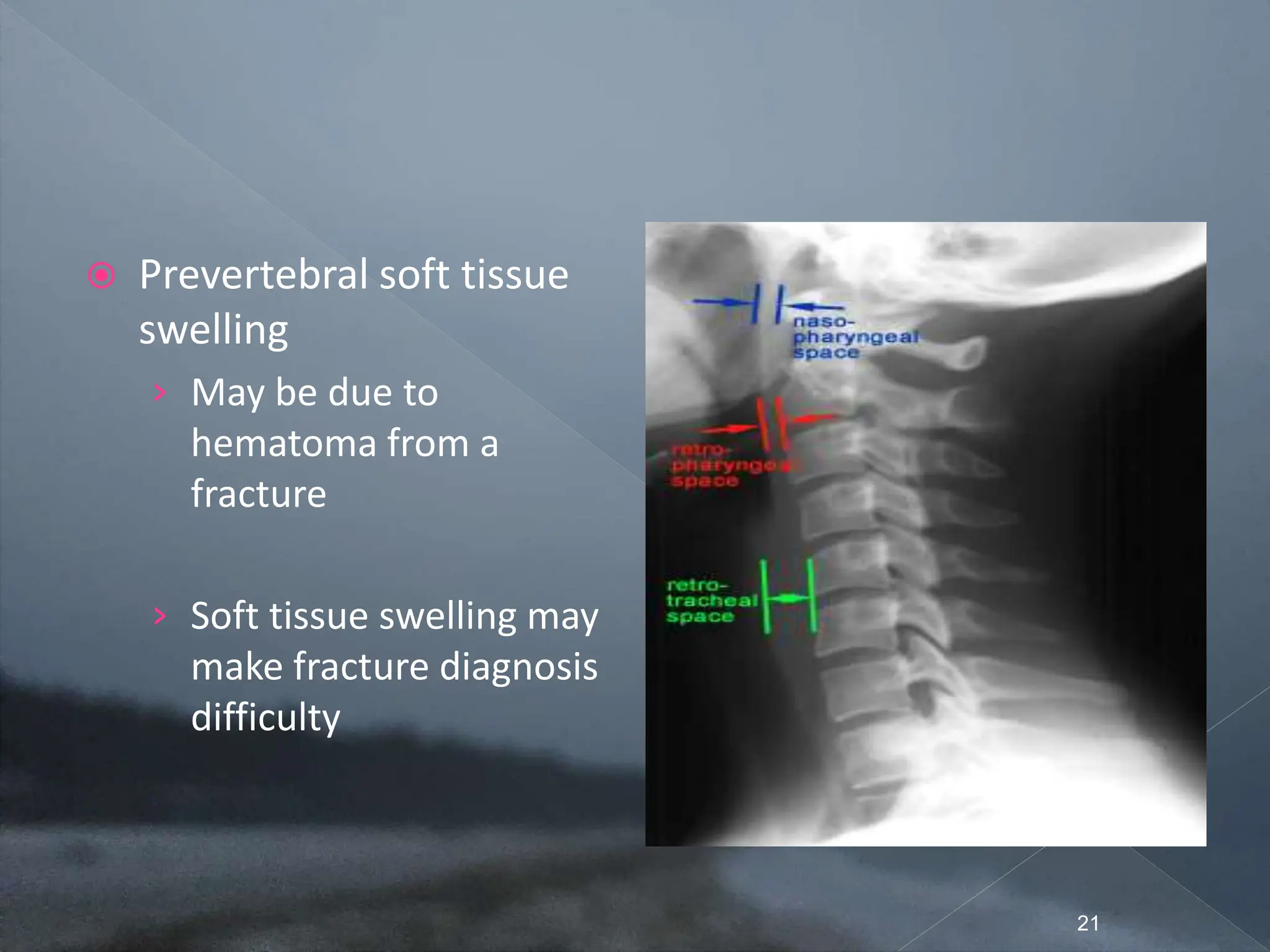 fractures of cervical spine and applied anatomy revised.pptx