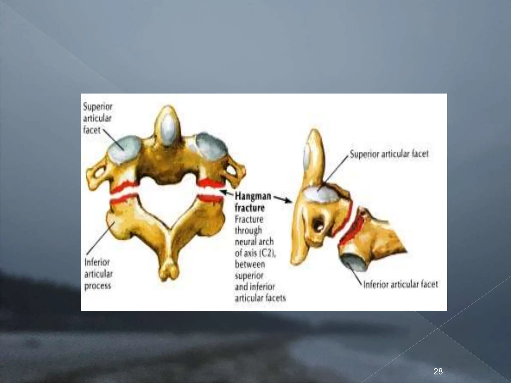 fractures of cervical spine and applied anatomy revised.pptx