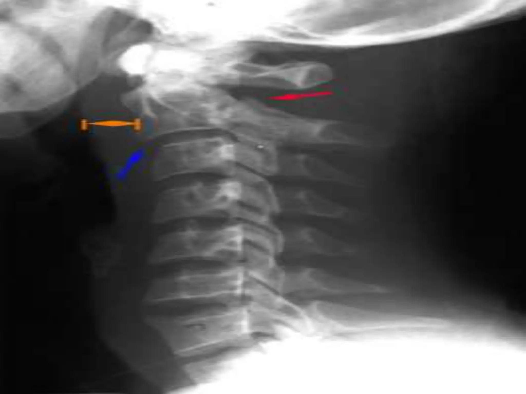fractures of cervical spine and applied anatomy revised.pptx
