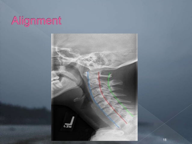 fractures of cervical spine and applied anatomy revised.pptx