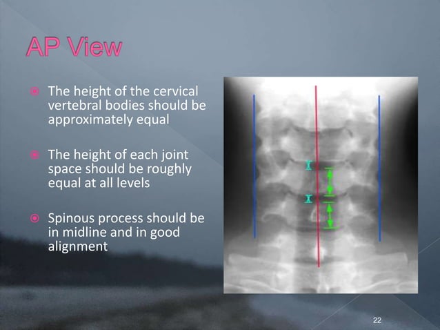 fractures of cervical spine and applied anatomy revised.pptx