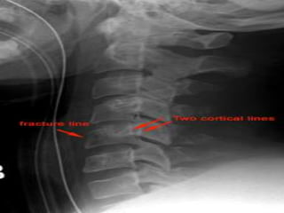 fractures of cervical spine and applied anatomy revised.pptx