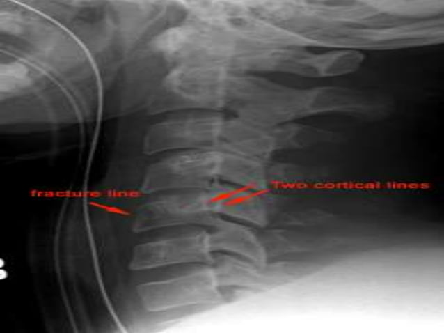 fractures of cervical spine and applied anatomy revised.pptx
