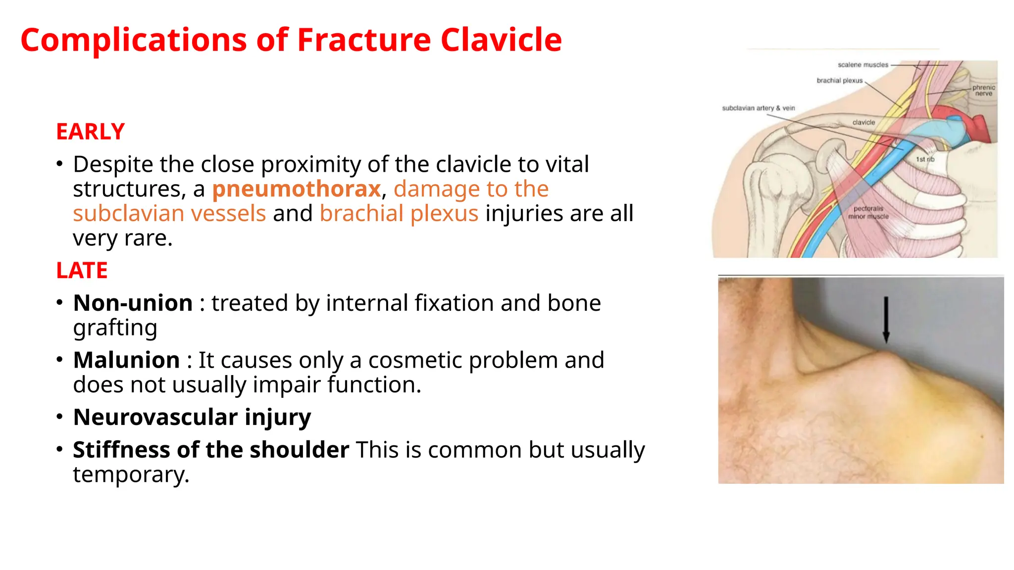 The Fractures of clavicle & scapula.pptx