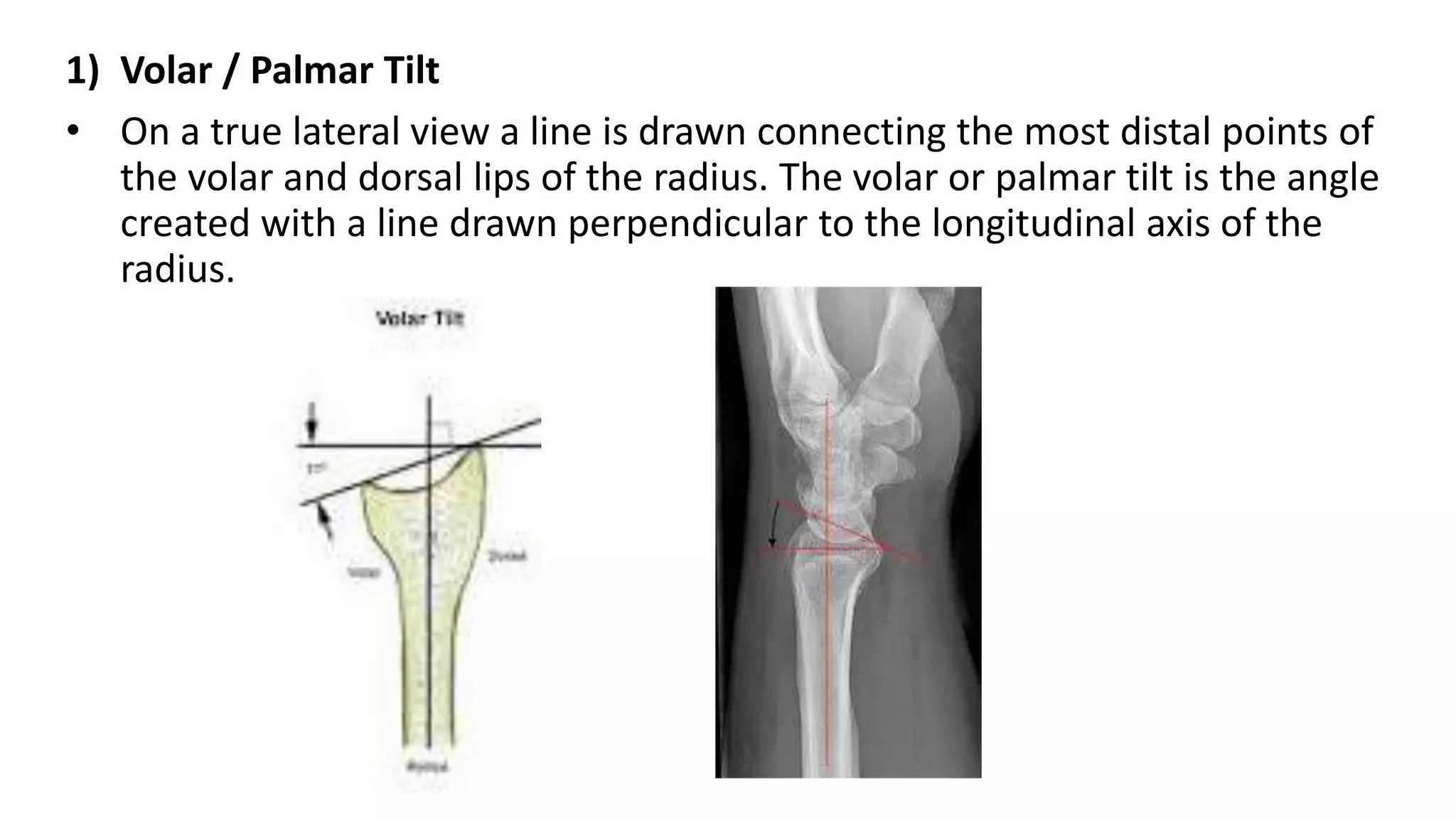 Fractures of distal end radius | PPTX