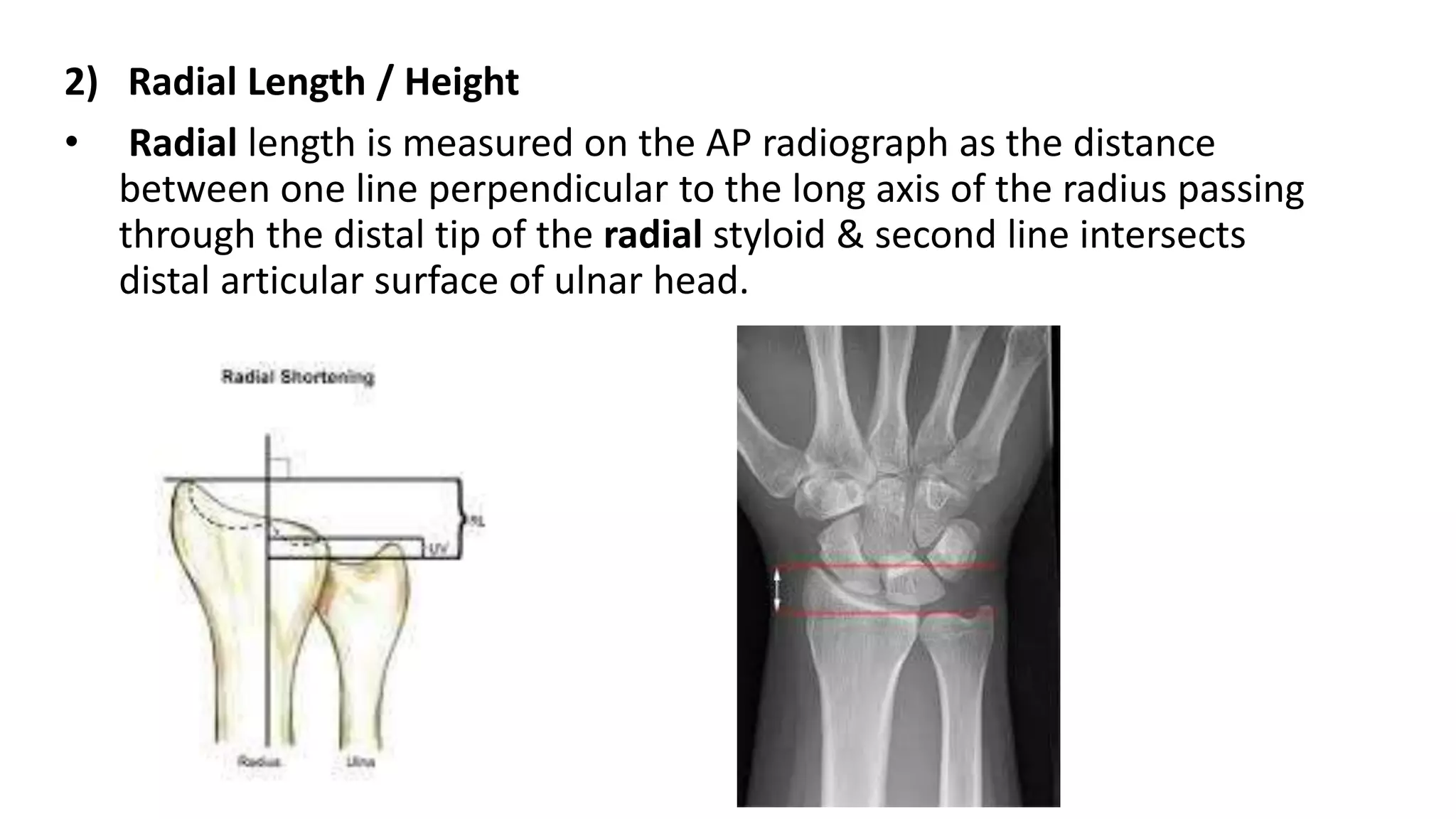Fractures of distal end radius | PPTX