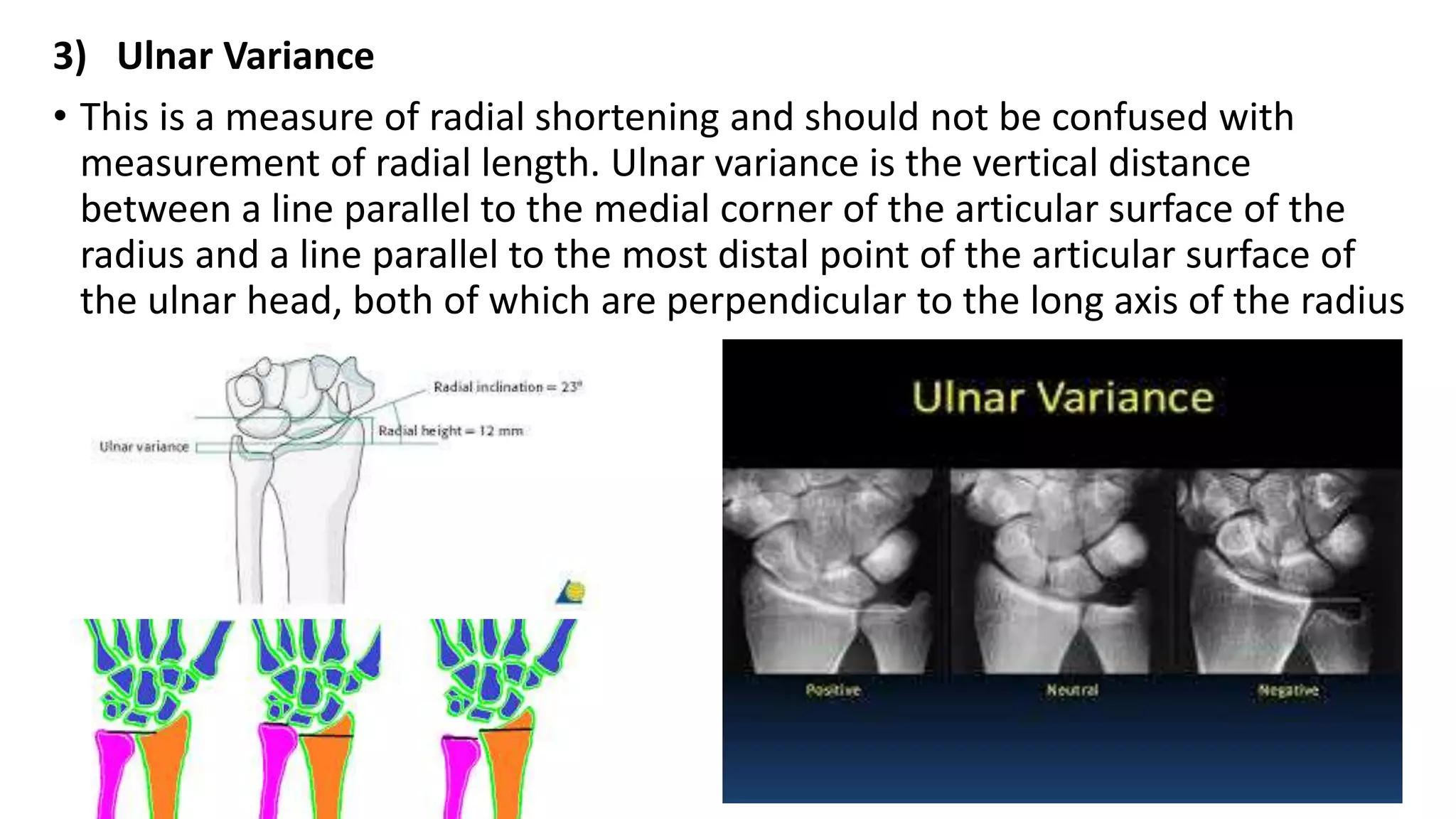 Fractures of distal end radius | PPTX
