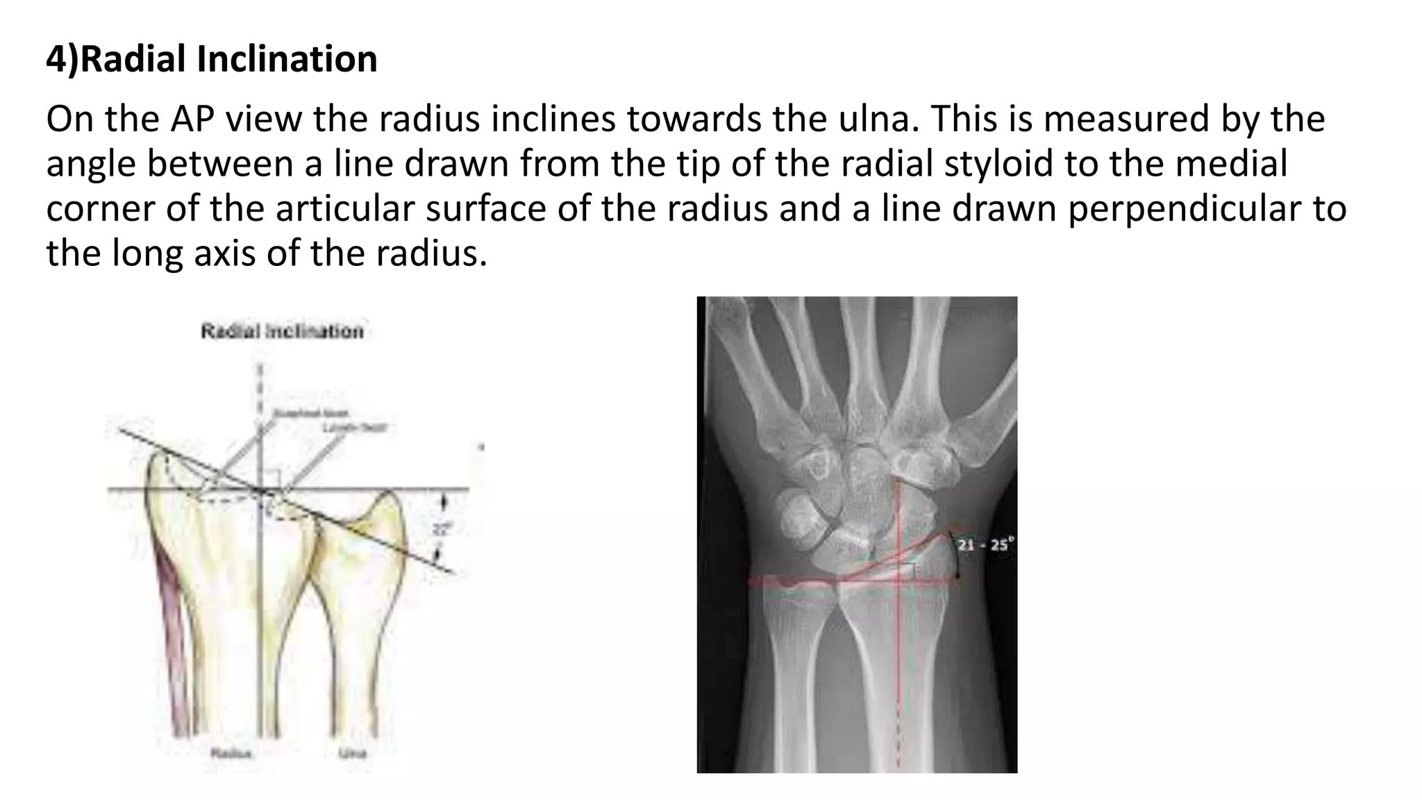 Fractures of distal end radius | PPTX