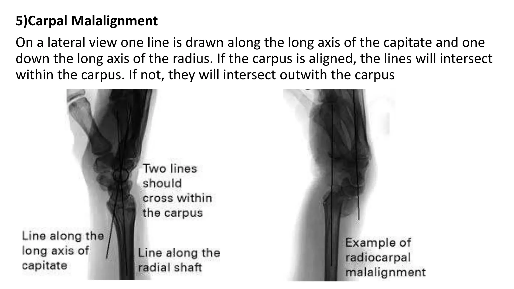 Fractures of distal end radius | PPTX