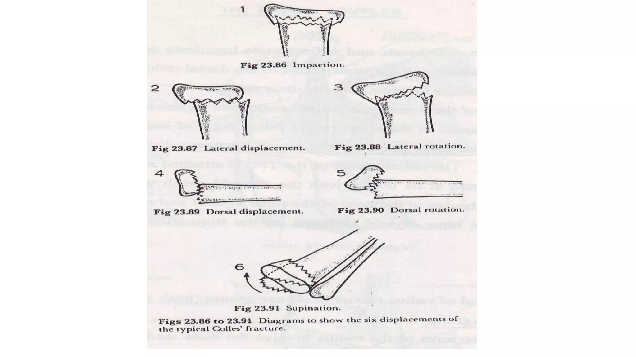 Fractures of distal end radius | PPTX