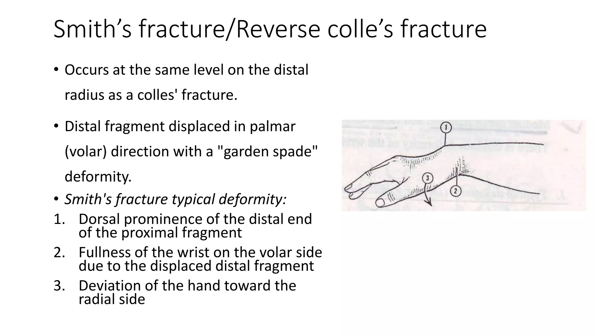Fractures of distal end radius | PPTX
