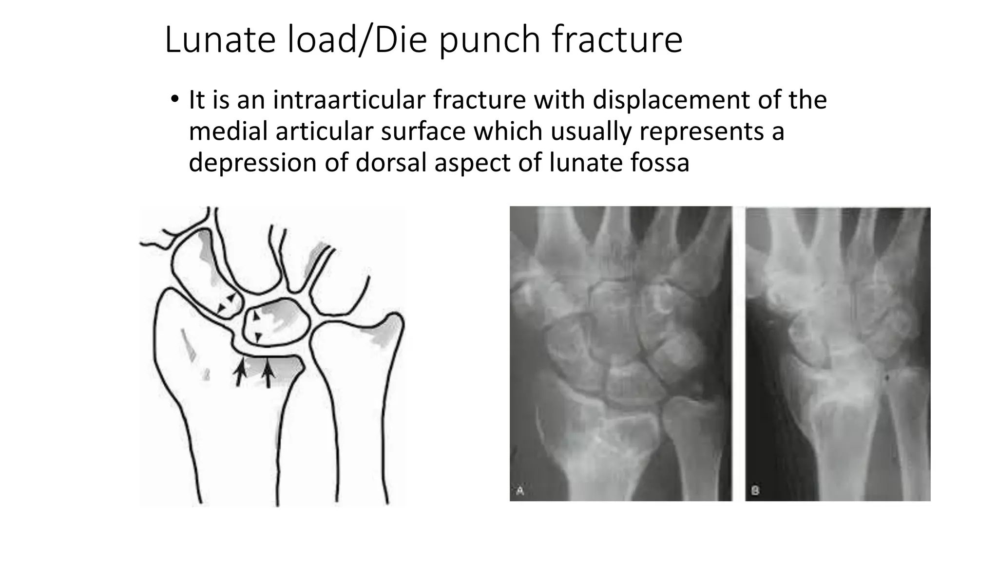 Fractures of distal end radius | PPTX