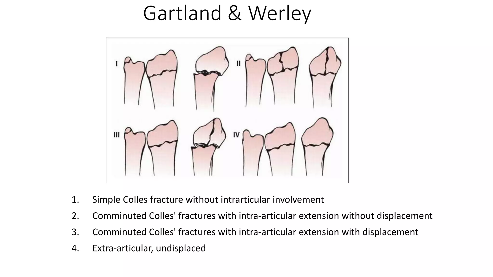 Fractures of distal end radius | PPTX
