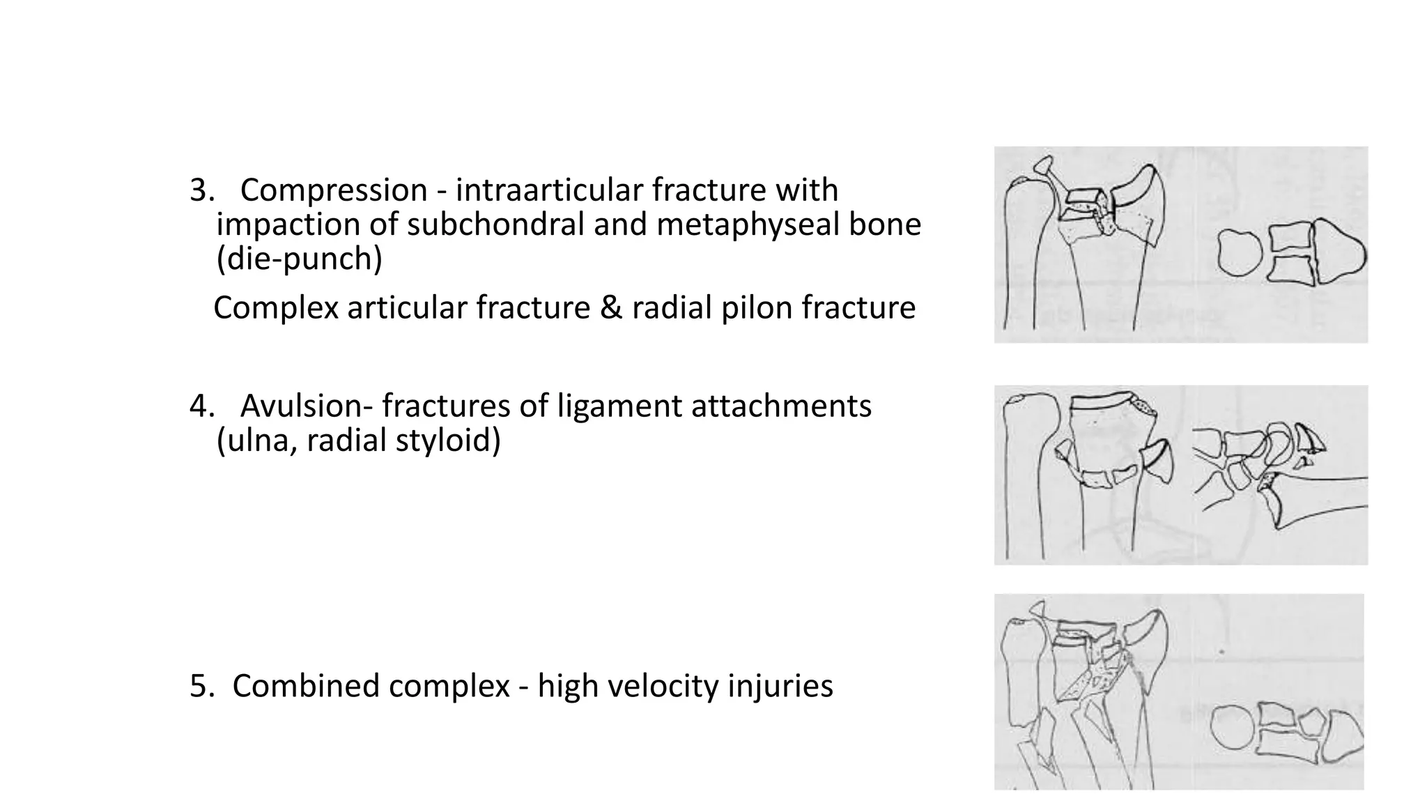 Fractures of distal end radius | PPTX