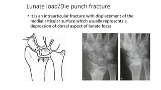 Die Punch Fracture