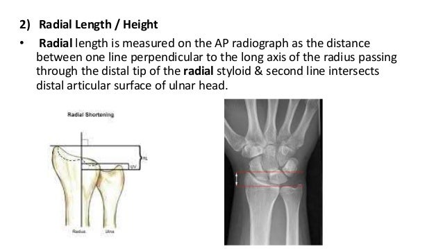 Fractures of distal end radius