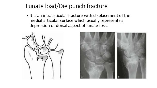 Fractures of distal end radius