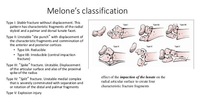 Fractures of distal end radius