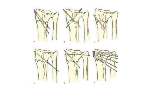 Distal Radius Fracture Kapandji Intrafocal Pinning Technique