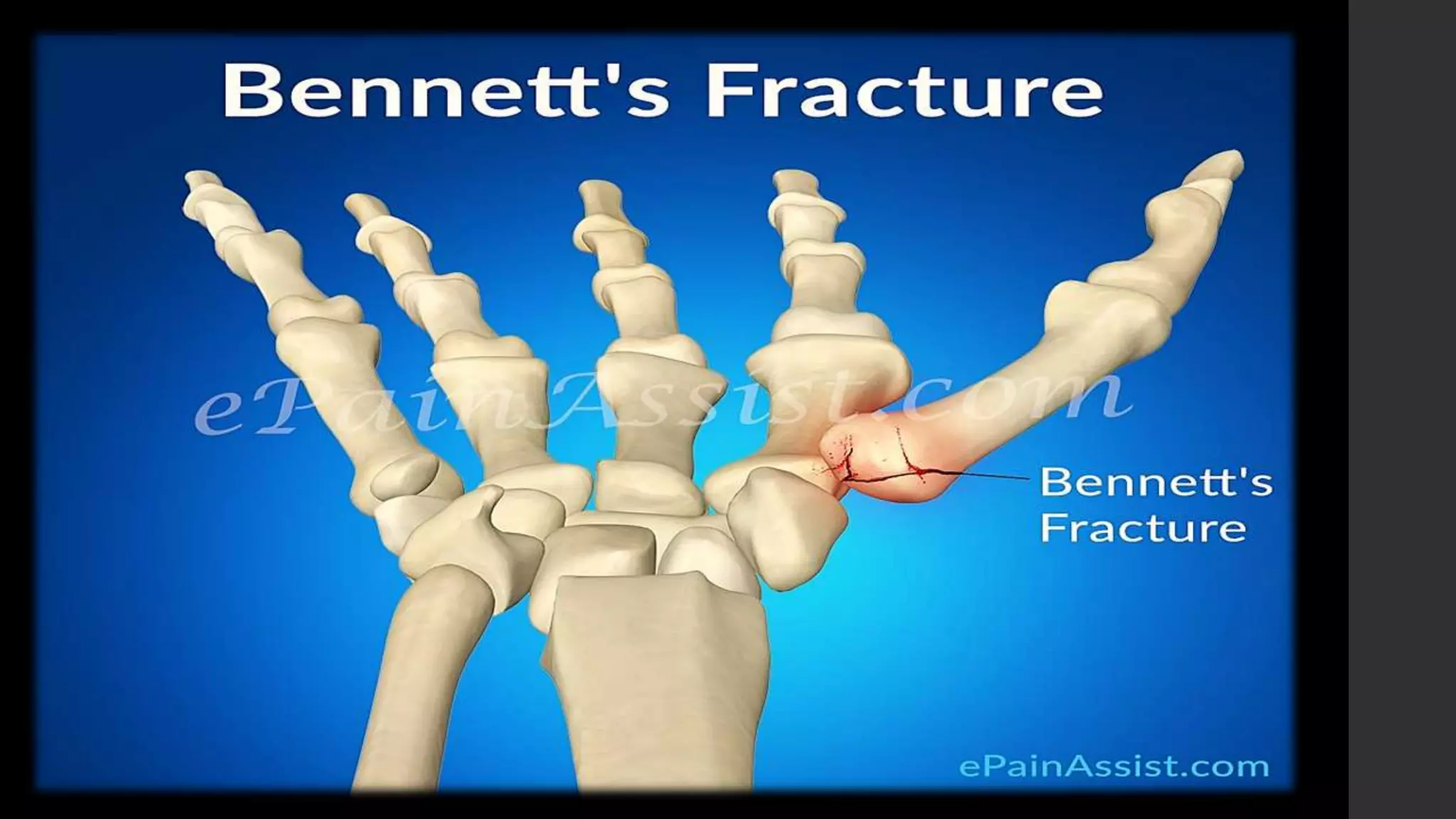 FRACTURES OF HAND | PPTX