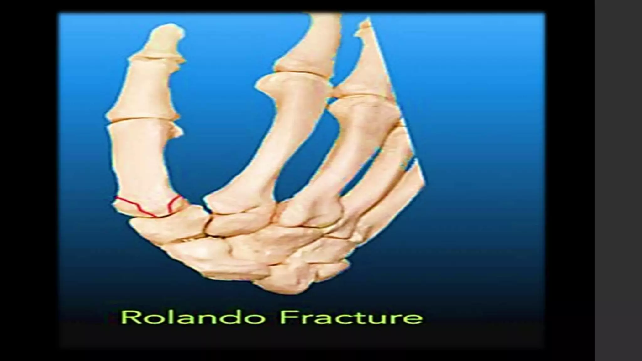 FRACTURES OF HAND | PPTX