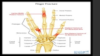 FRACTURES OF HAND | PPTX
