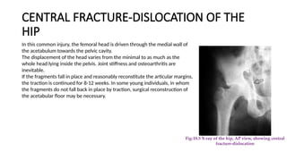Hip Fractures: Types & Management // Fractures of Hip | PPTX