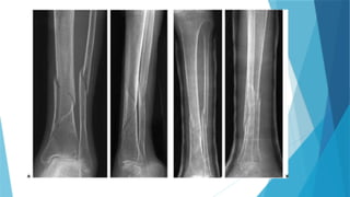 Fractures of Leg and Foot orthopedics campbell | PPTX