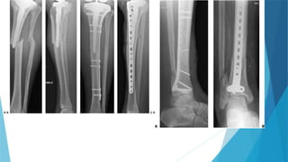 Fractures of Leg and Foot orthopedics campbell | PPTX