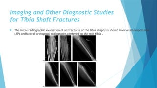 Fractures of Leg and Foot orthopedics campbell | PPTX