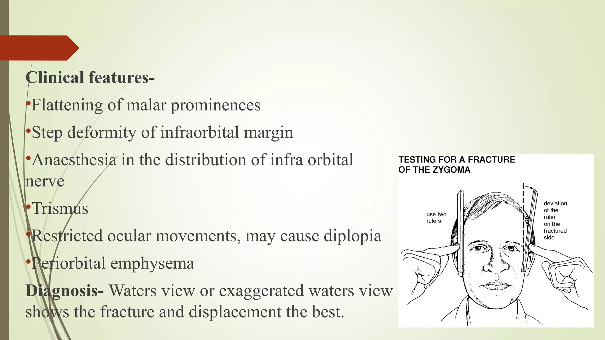 Fractures of middle third of face | PPT