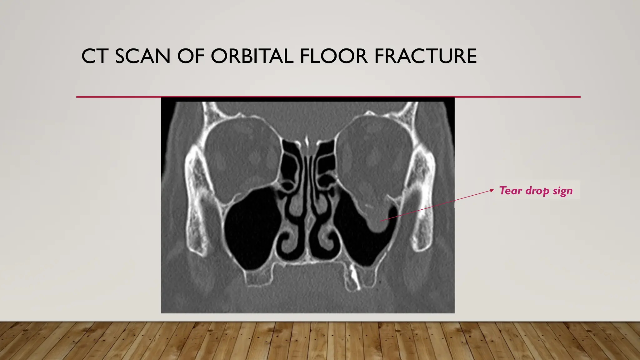 Fractures of Orbital Floor and Maxilla.pptx