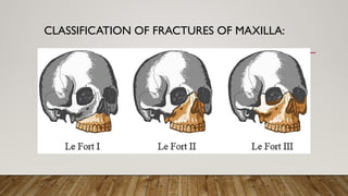 Fractures of Orbital Floor and Maxilla.pptx