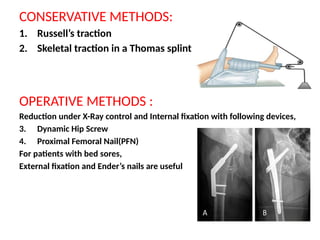 FRACTURES OF PROXIMAL FEMUR ORTHOPEDICS.pptx