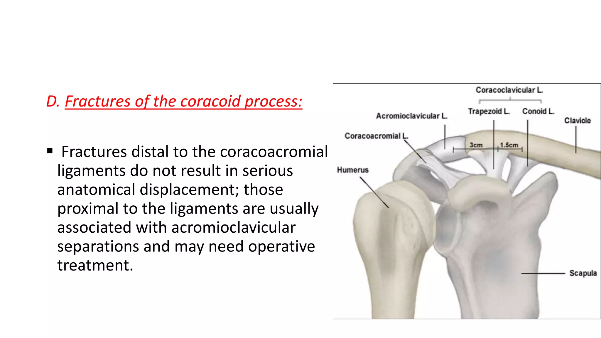 Fractures of scapula | PPTX