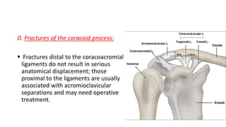 Fractures of scapula | PPTX