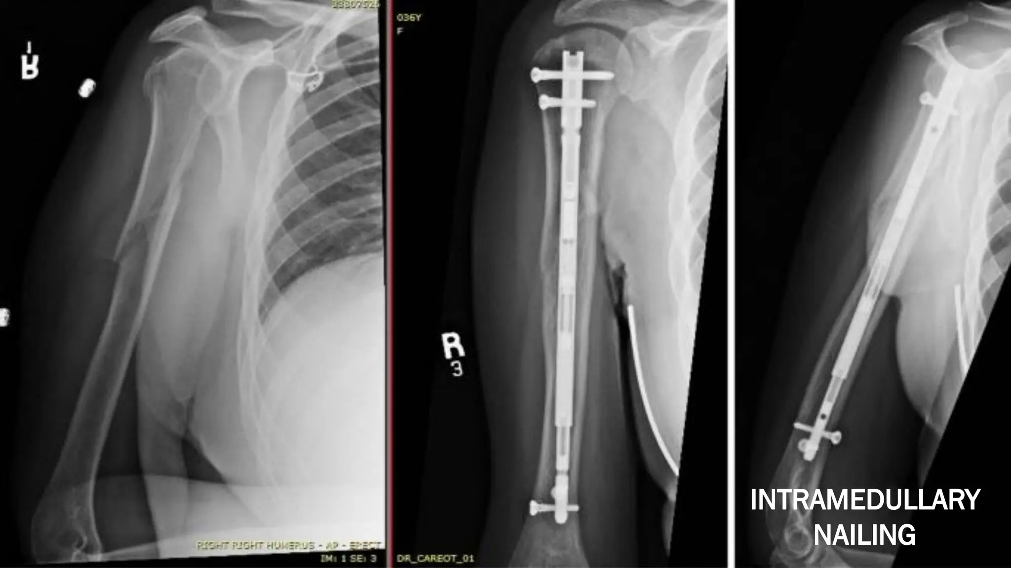FRACTURES OF SHAFT OF HUMERUS - ORTHOPEDICS PRESENTATION | PDF