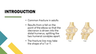 FRACTURES OF SHAFT OF HUMERUS - ORTHOPEDICS PRESENTATION | PDF