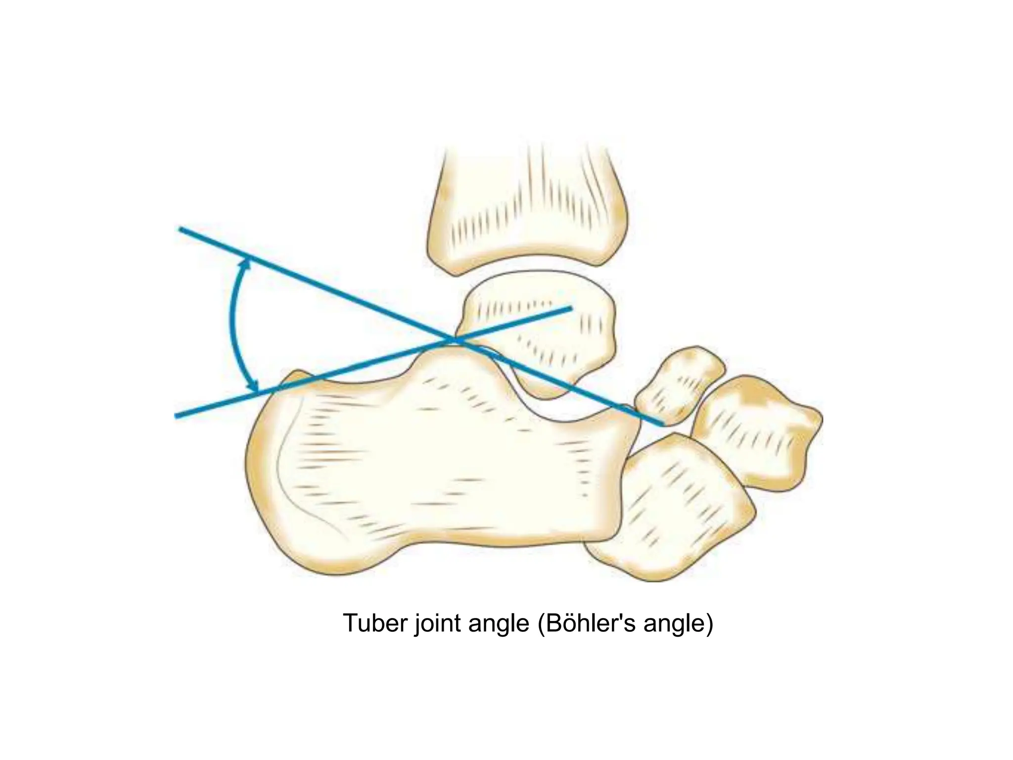 Fractures of the calcaneum.pptx. . | PPTX
