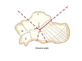 Fractures of the calcaneum.pptx. . | PPTX