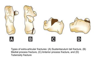 Fractures of the calcaneum.pptx. . | PPTX