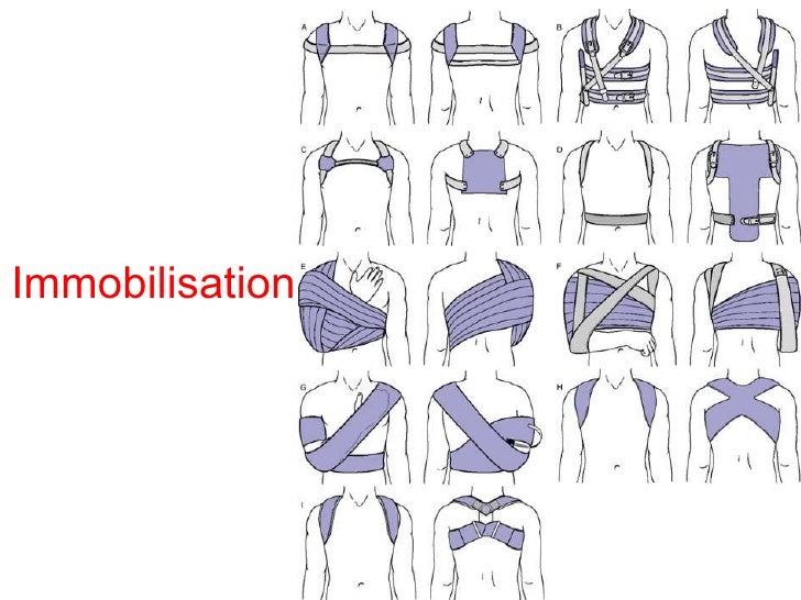 Fractures of the clavicle