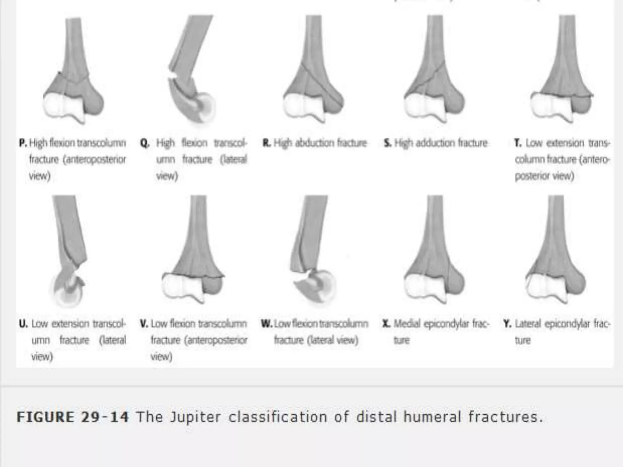 Fractures of the distal humerus ppt | PPTX