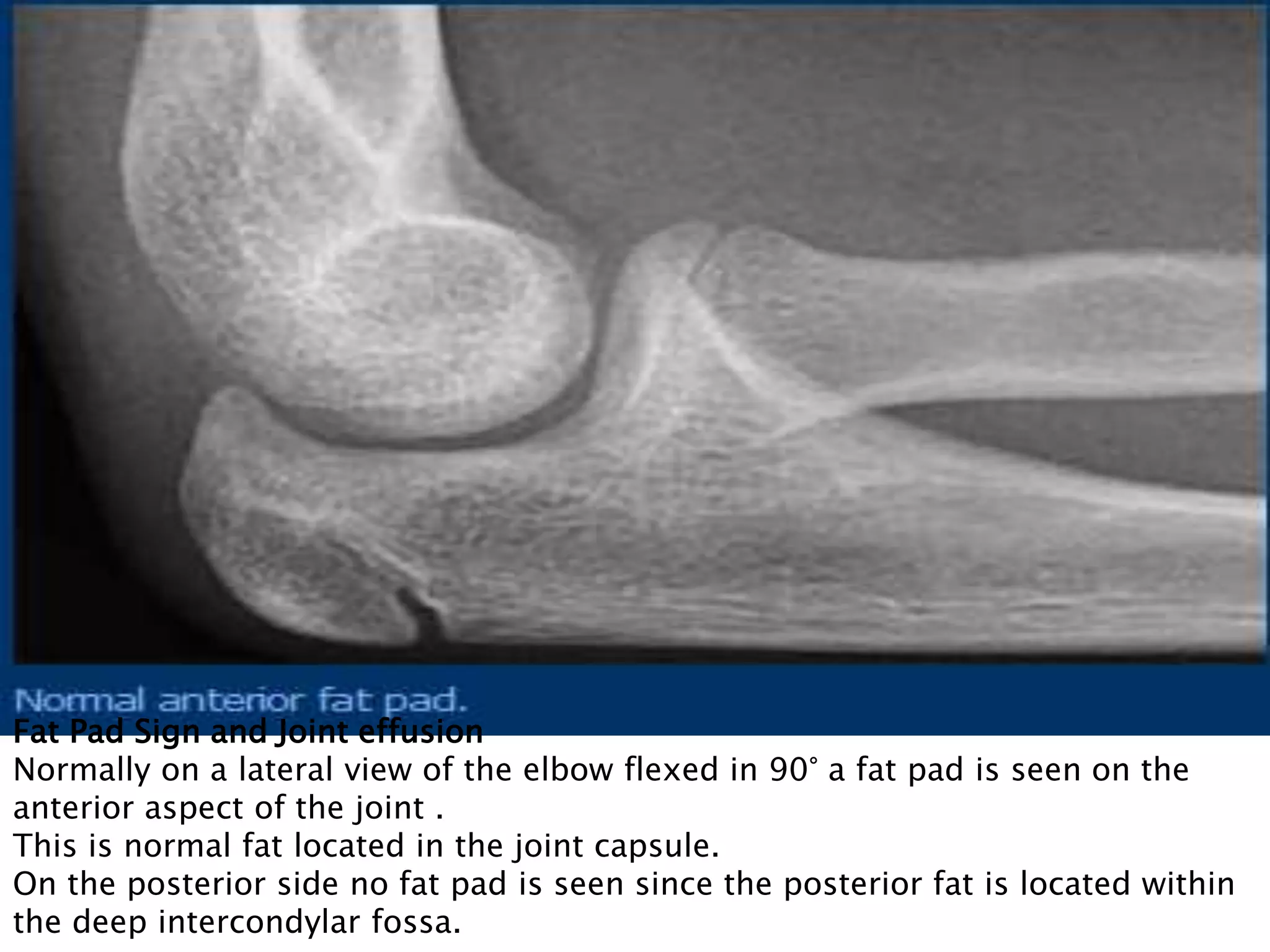 Fractures of the distal humerus ppt | PPTX
