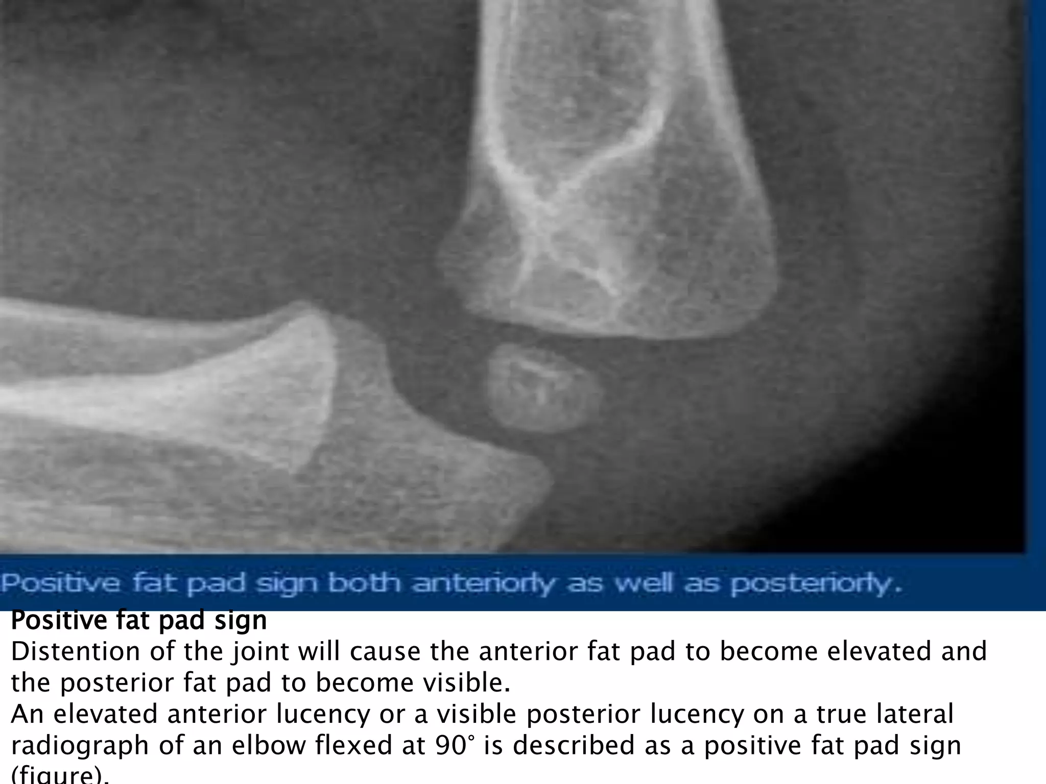 Fractures of the distal humerus ppt | PPTX